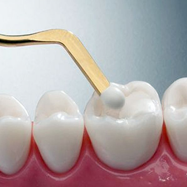 Rellenos dentales de resina (blancos)